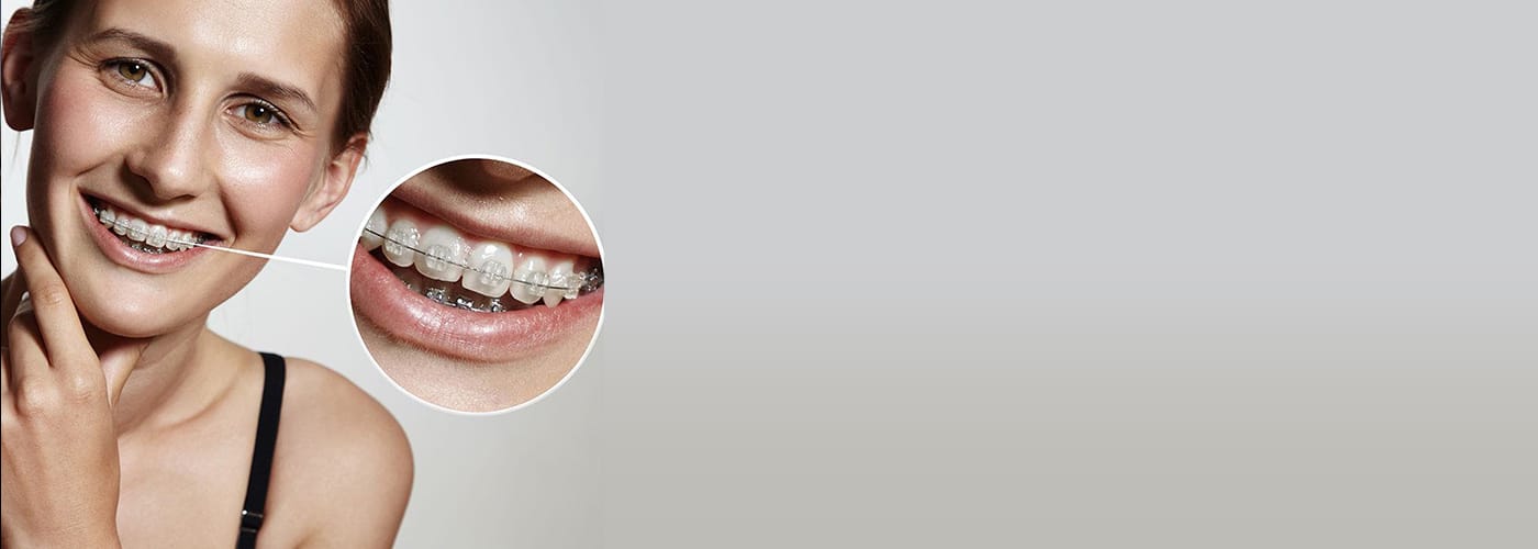 Fixed Clear Braces in Amersham | Straighten Teeth Amersham
